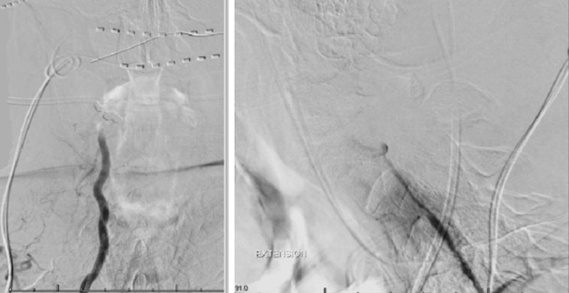 Right Vertebral Artery Compression Syndrome | NSPC Brain & Spine Surgery